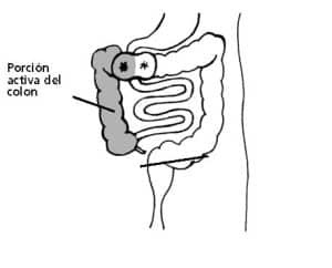 ¿Qué es una Colostomía? – Colostomía