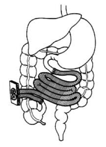 ¿Qué es una Ileostomía? - Colostomía